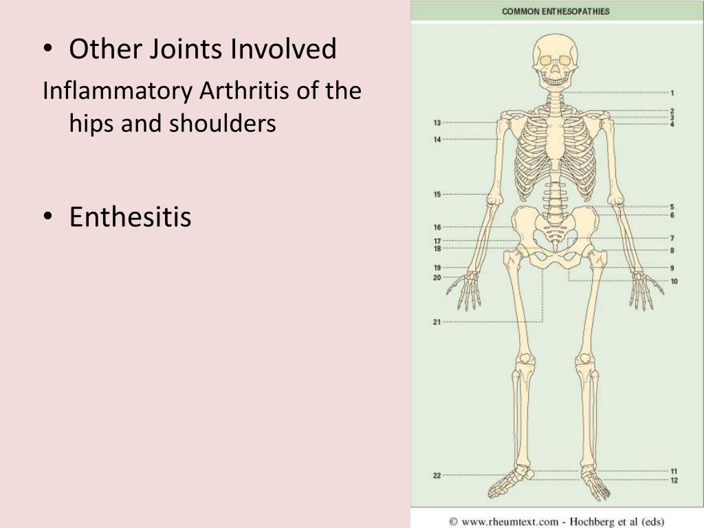 PPT - Seronegative Arthritis Or Spondyloartropaties PowerPoint ...
