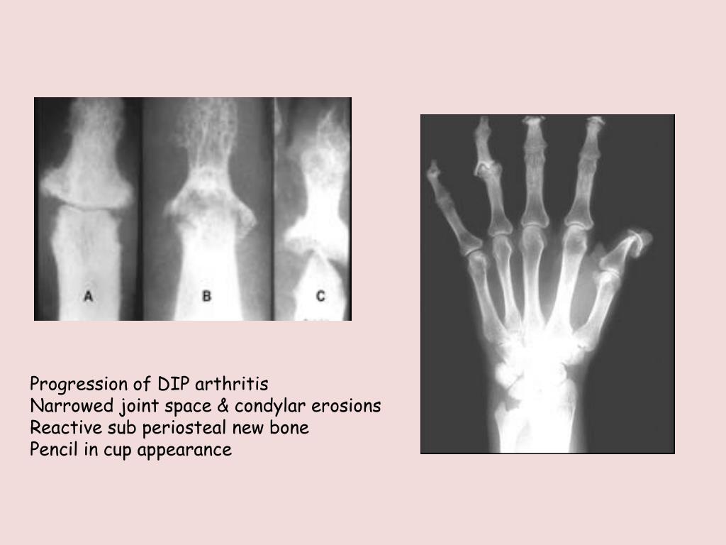 PPT - Seronegative Arthritis Or Spondyloartropaties PowerPoint ...