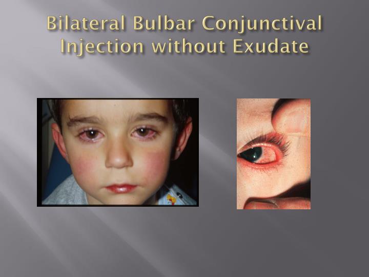 PPT - Kawasaki Disease PowerPoint Presentation - ID:2137237