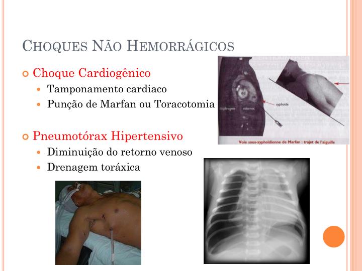 PPT - ATLS - C Circulação com controle da Hemorragia PowerPoint ...
