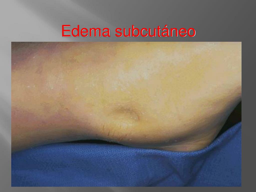 PPT - Trastornos hemodinamicos –enfermedad tromboembolica y choque ...