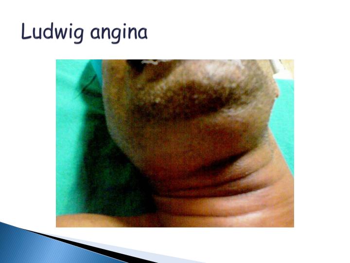 PPT - Neck Swelling Differential Diagnosis PowerPoint Presentation - ID ...