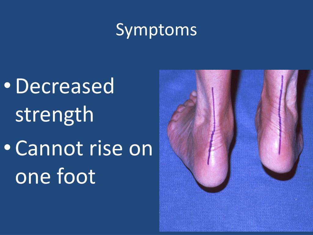PPT - My Ankle…Posterior Tibial Tendon Insufficiency PowerPoint ...