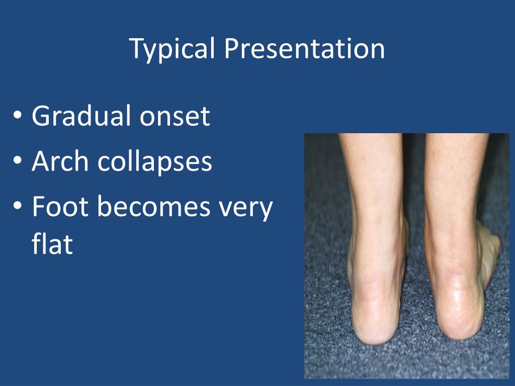PPT - My Ankle…Posterior Tibial Tendon Insufficiency PowerPoint ...
