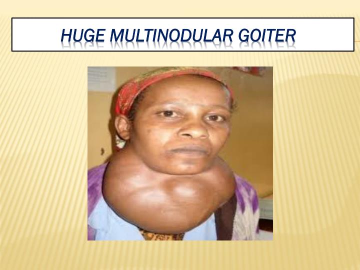 PPT - DISEASES OF THYROID GLAND 1 PowerPoint Presentation - ID:2141406