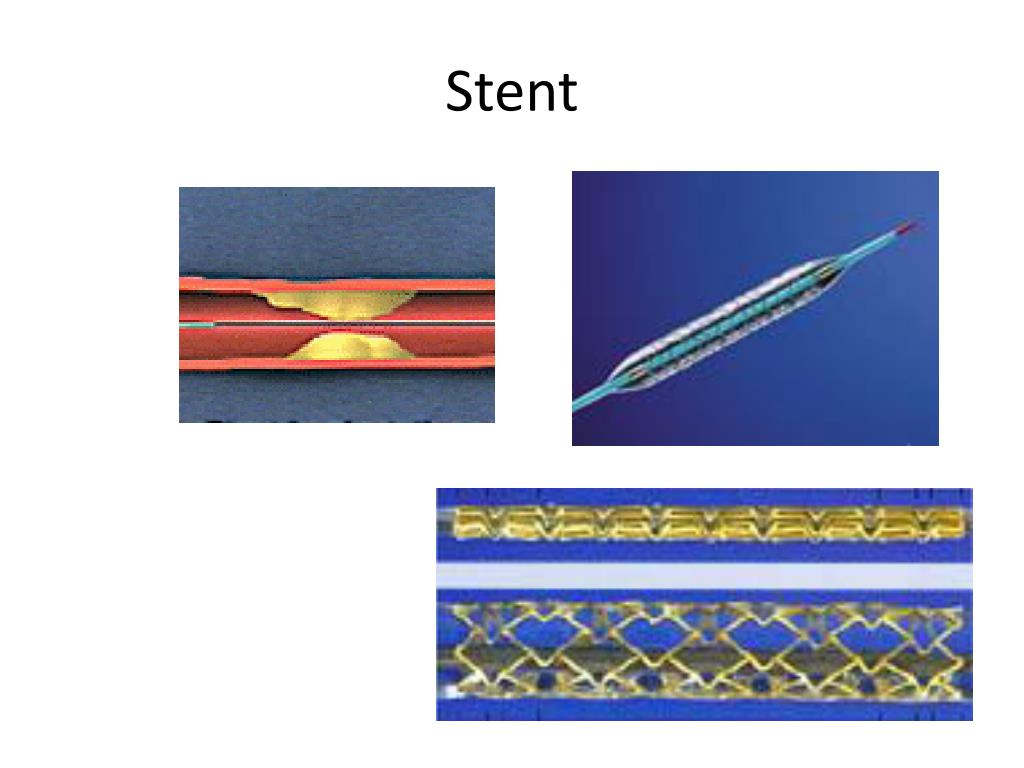 PPT - GENETIC SUSCEPTABILITY OF ISCHEMIC HEART DISEASE (IHD ...