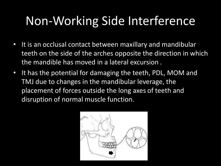 PPT - Fundamentals Of Occlusion PowerPoint Presentation - ID:2143561