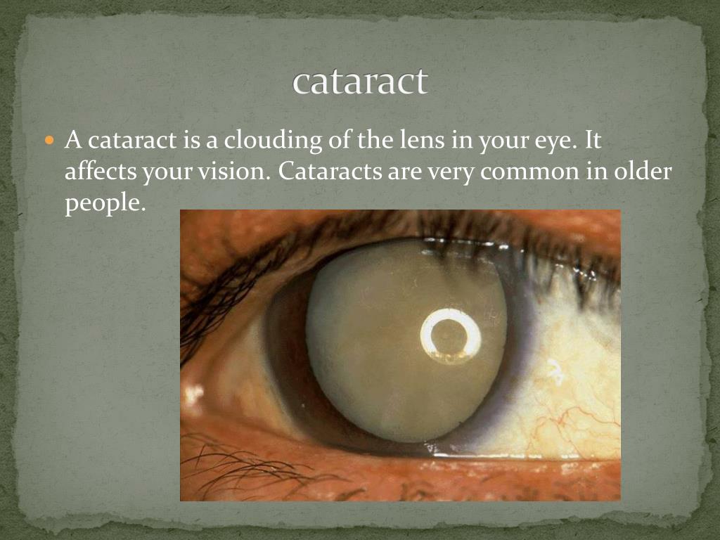 PPT - Understanding Achromatopsia and Common Eye Conditions PowerPoint ...