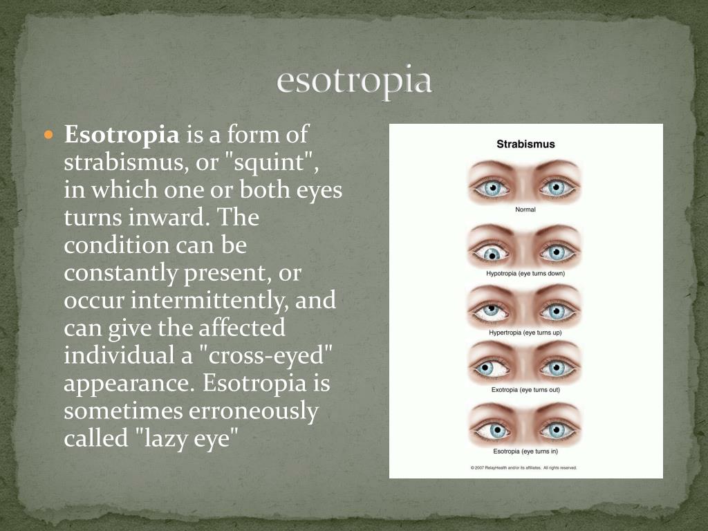 PPT - Eye Signs, Symptoms, and Diseases PowerPoint Presentation, free ...