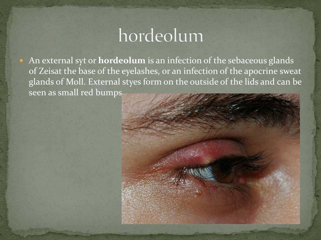 PPT - Eye Signs, Symptoms, and Diseases PowerPoint Presentation, free ...