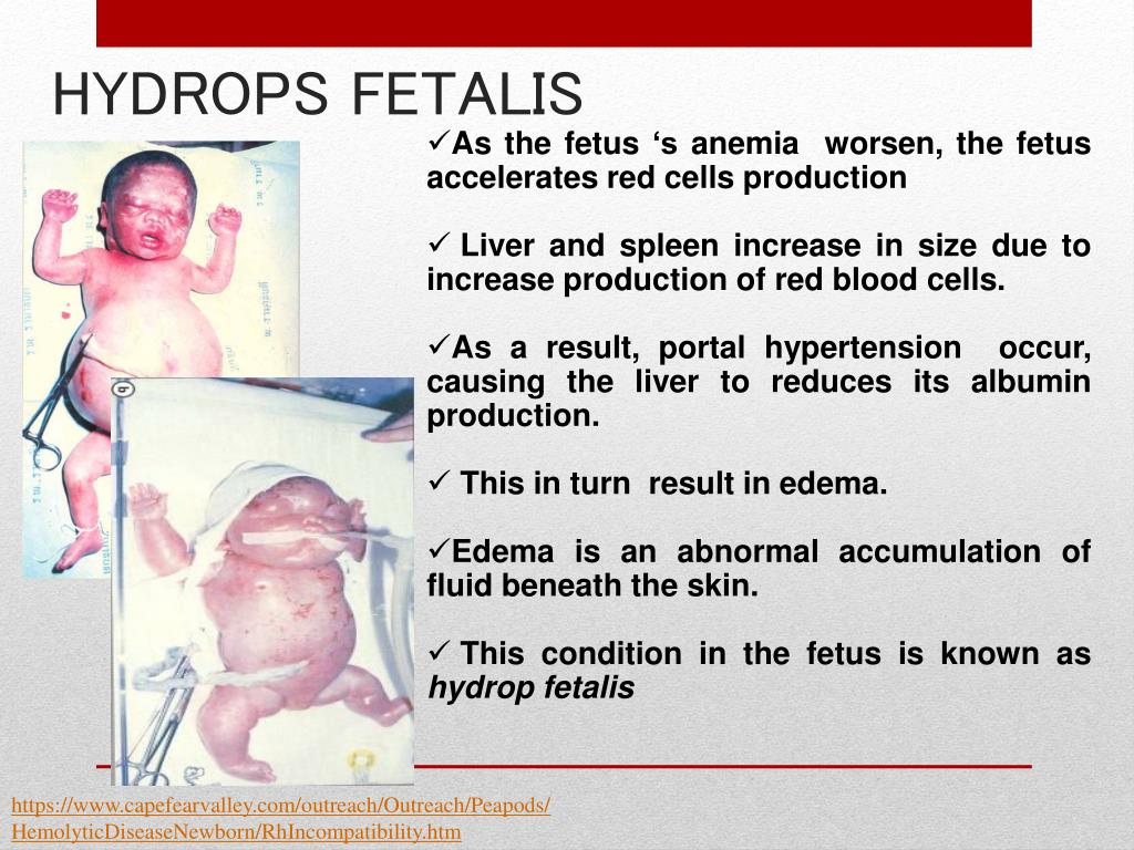 PPT - HEMOLYTIC DISEASE OF NEWBORN (HDN) PowerPoint Presentation, free ...