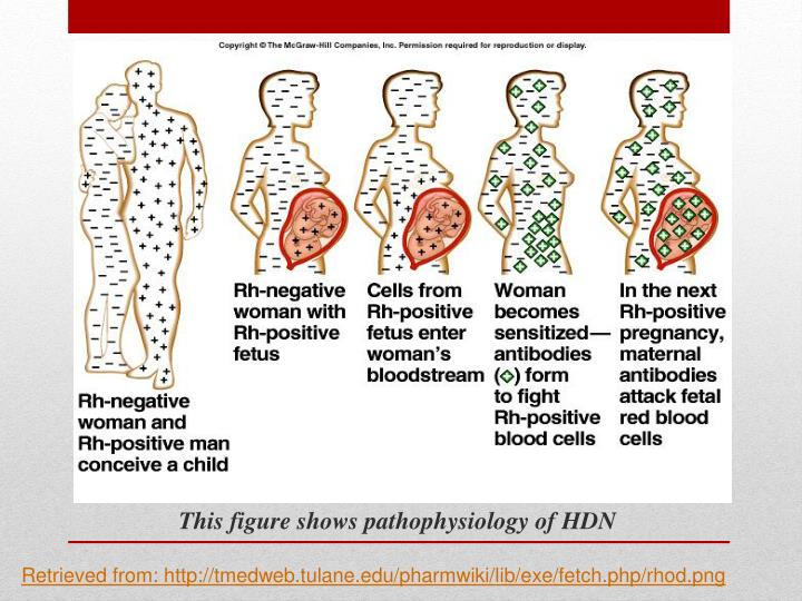 PPT - HEMOLYTIC DISEASE OF NEWBORN (HDN) PowerPoint Presentation - ID ...