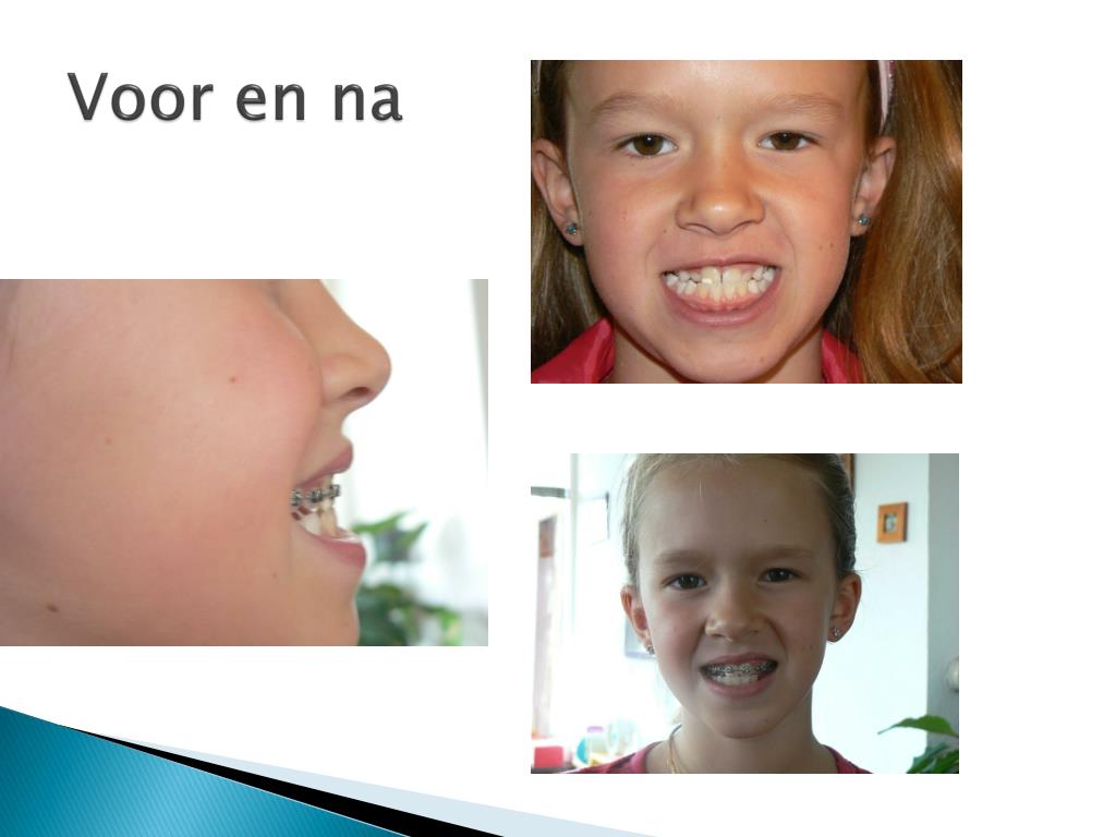 PPT - Ik doe mijn spreekbeurt over beugels PowerPoint Presentation ...