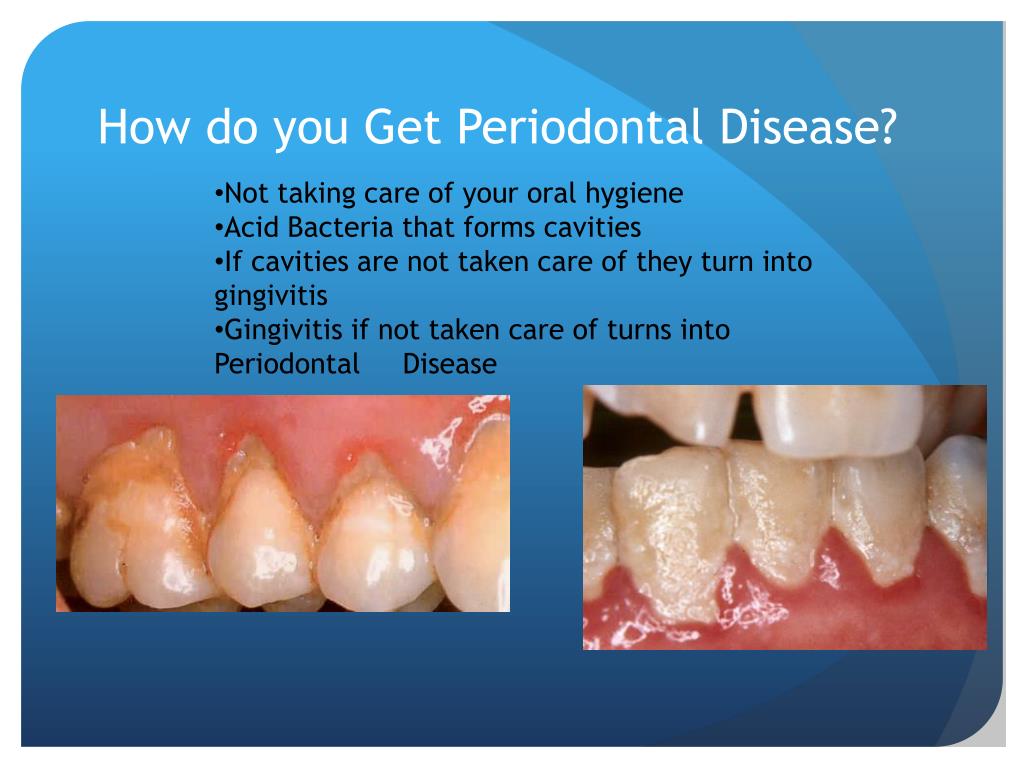 PPT - Periodontal Disease in Pregnancy PowerPoint Presentation, free ...