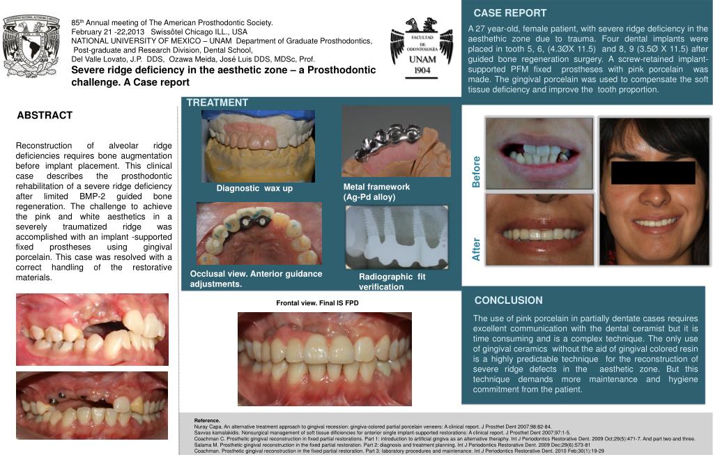 PPT - 85 th Annual meeting of The American Prosthodontic Society ...