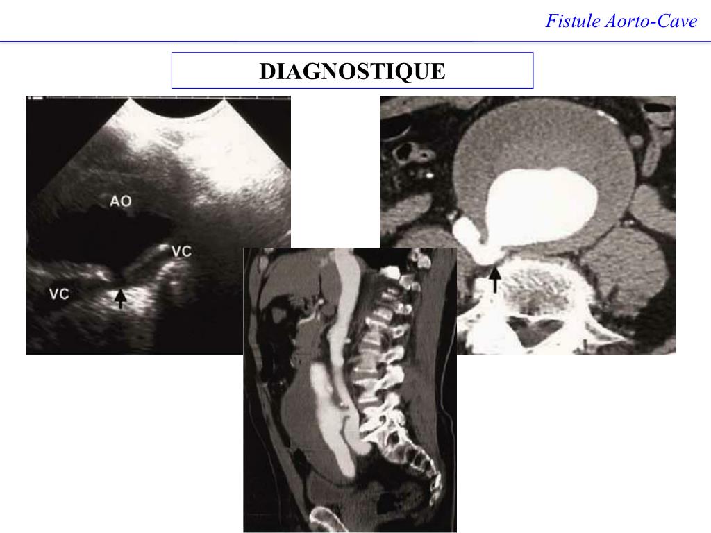 PPT - Chirurgie VASCULAIRE, THORACIQUE et TRANSPLANTATION PULMONAIRE ...