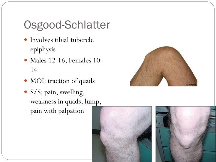PPT - Ch. 18 Knee Injuries PowerPoint Presentation - ID:2147623