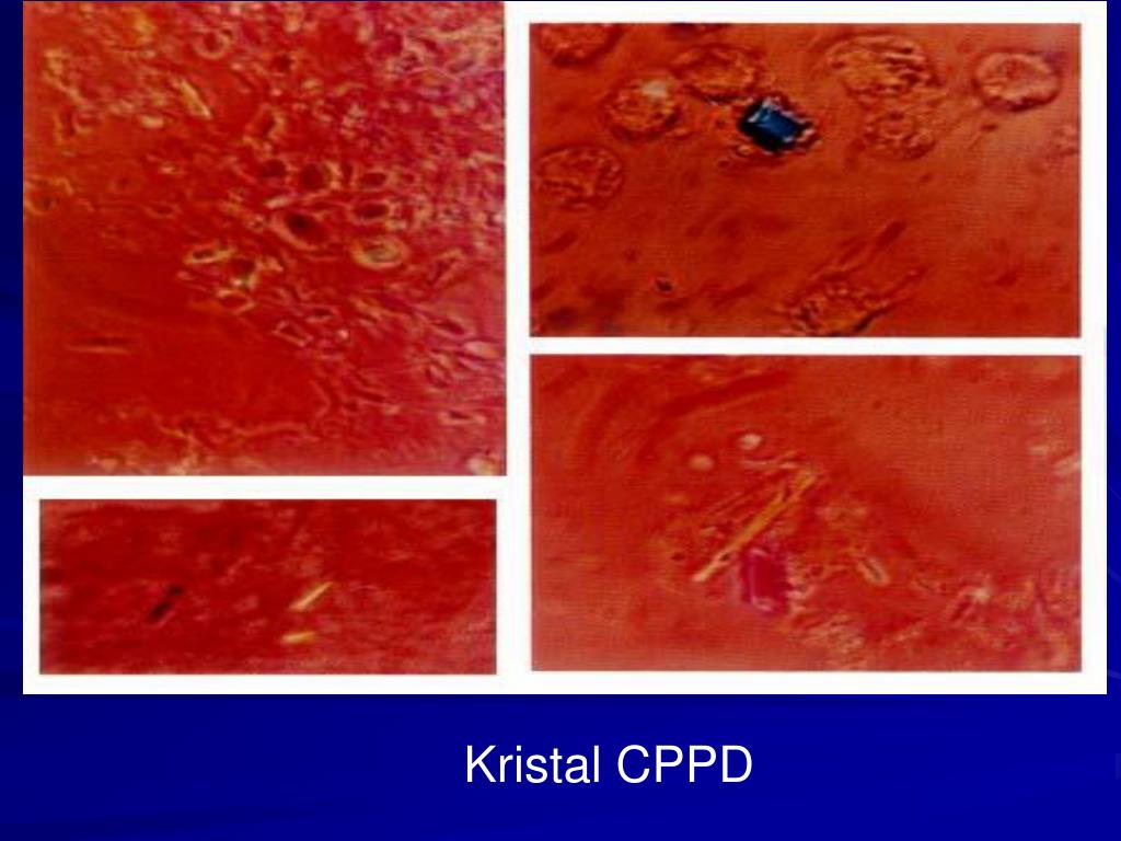 PPT - PENYAKIT METABOLIK PADA MUSKULOSKLETAL Artritis gout Pseudogout ...