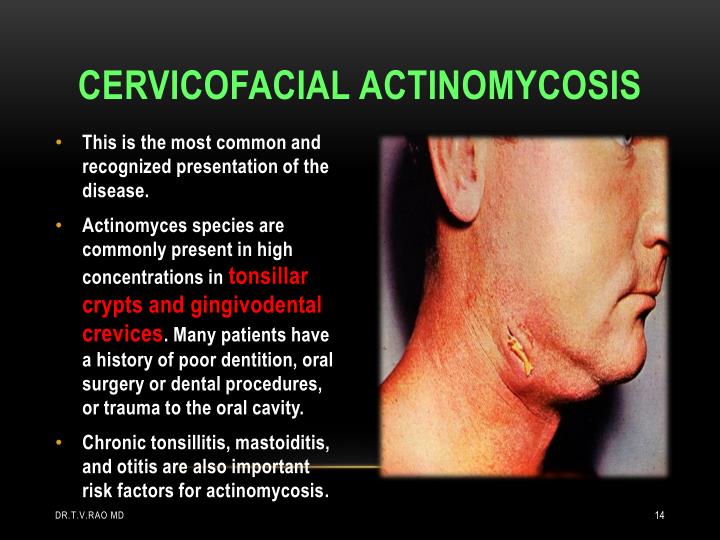 PPT - ACTINOMYCOSIS PowerPoint Presentation - ID:2152211