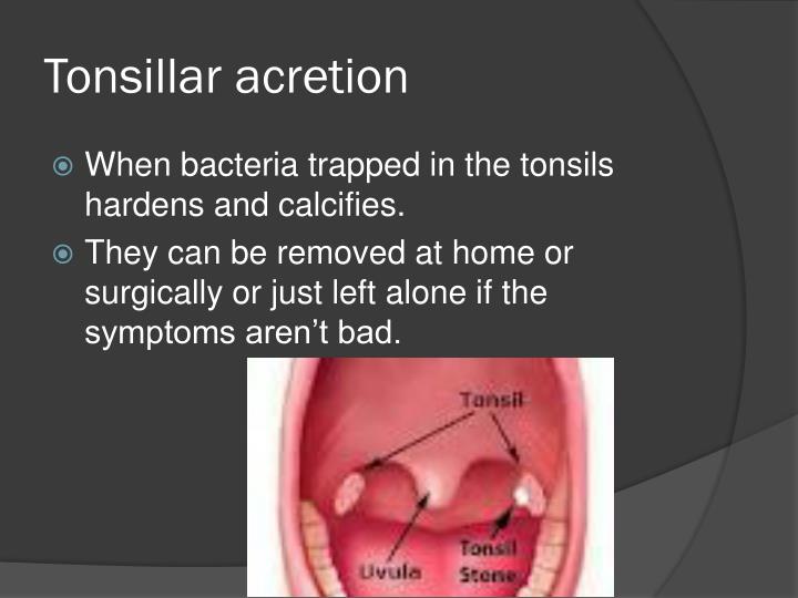 PPT - Tonsillitis PowerPoint Presentation - ID:2152221