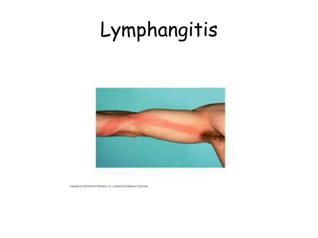 Lymphangitis Causes Symptoms Diagnosis Treatment QKXKE Lymphangitis Causes Symptoms Diagnosis Treatment QKXKE