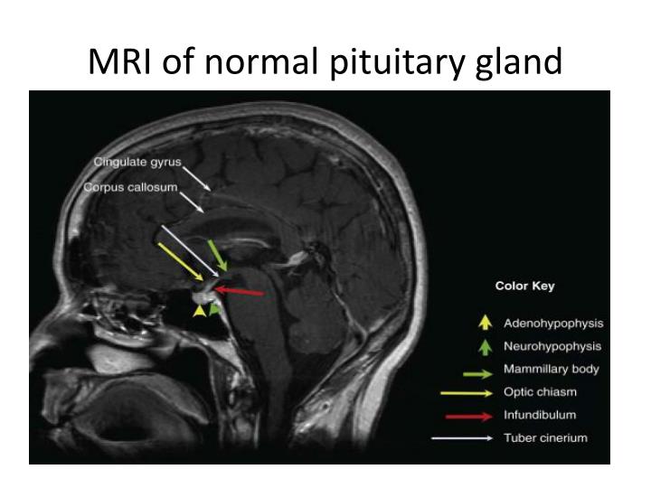 Pituitary Gland Tumor Mri