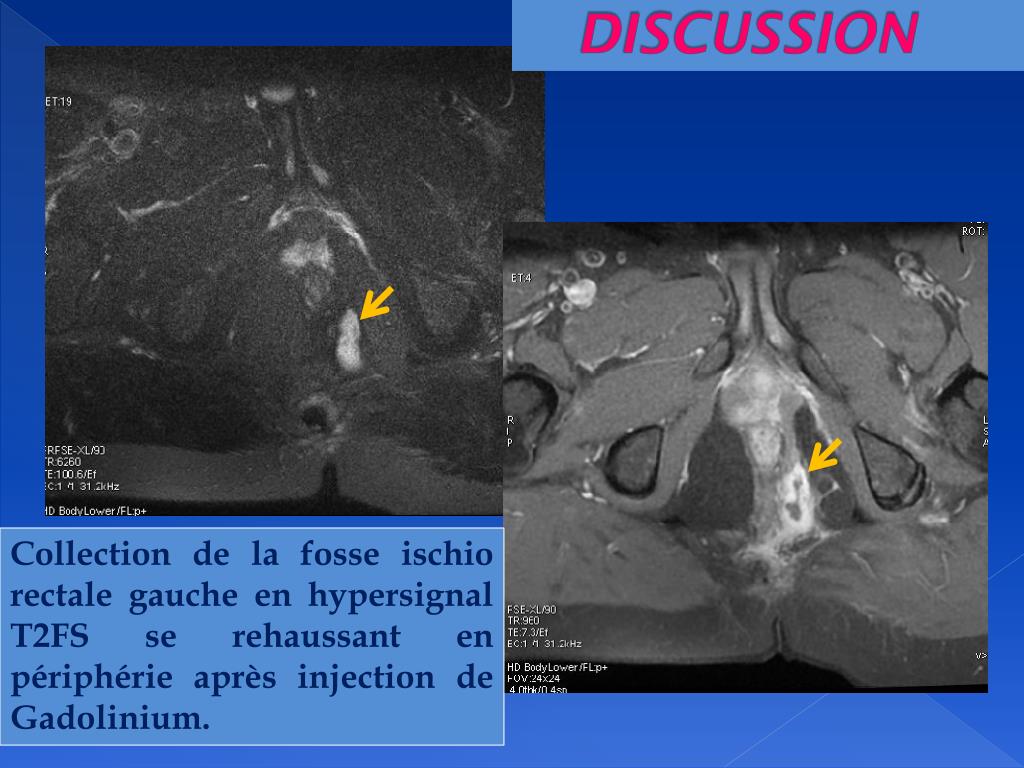 PPT - IRM des fistules ano périnéales PowerPoint Presentation, free ...