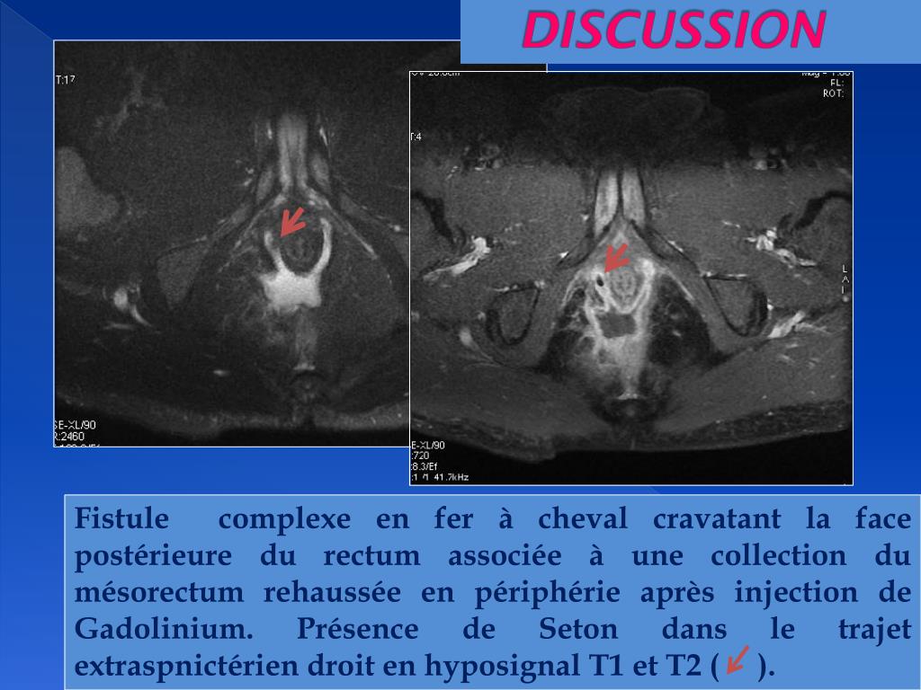 PPT - IRM des fistules ano périnéales PowerPoint Presentation, free ...