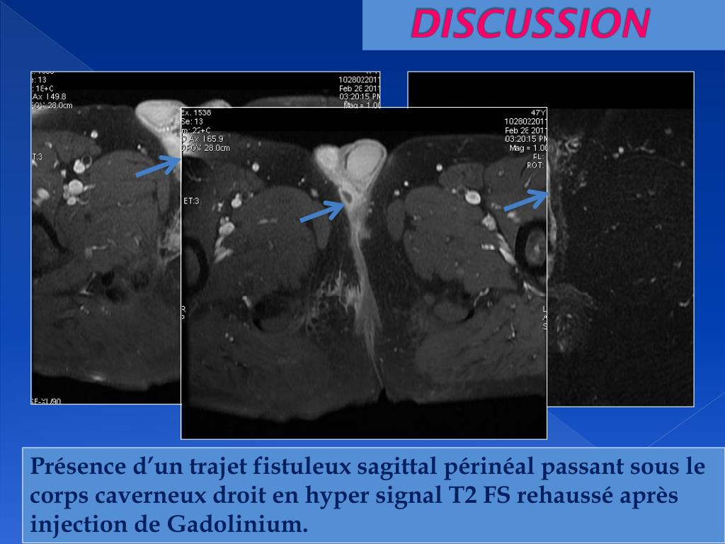 PPT - IRM des fistules ano périnéales PowerPoint Presentation, free ...