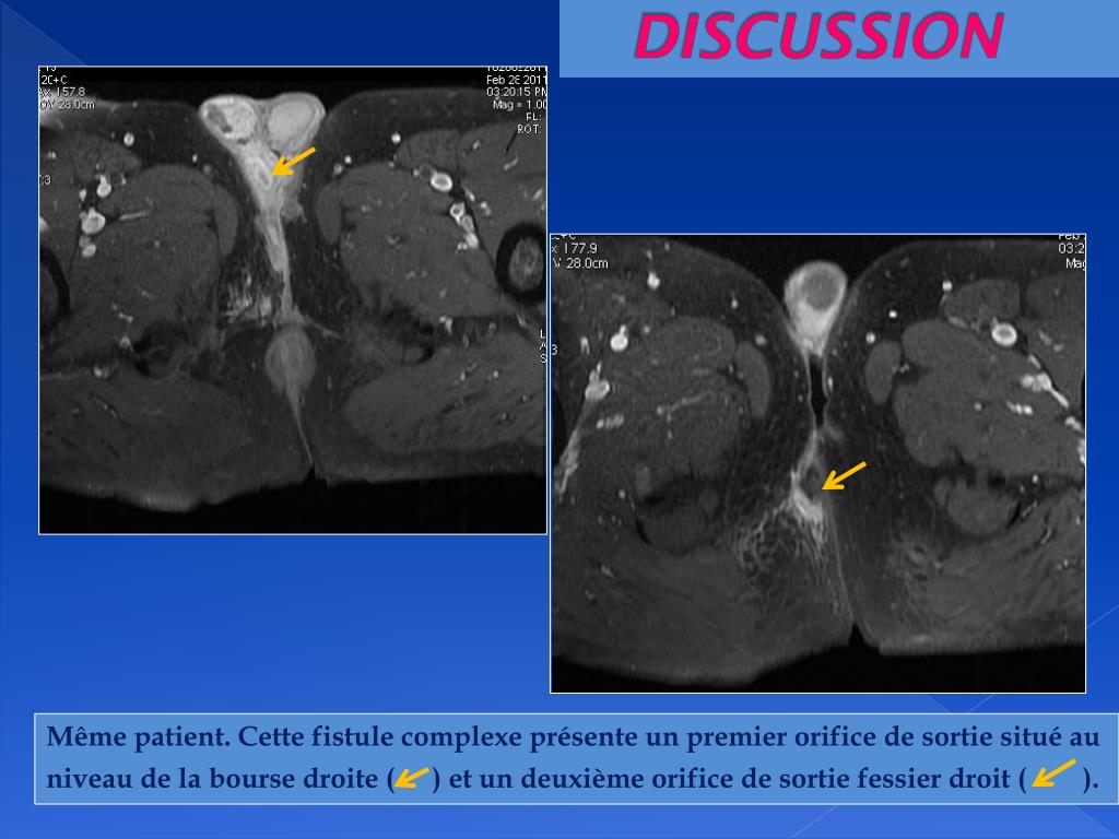 PPT - IRM des fistules ano périnéales PowerPoint Presentation, free ...