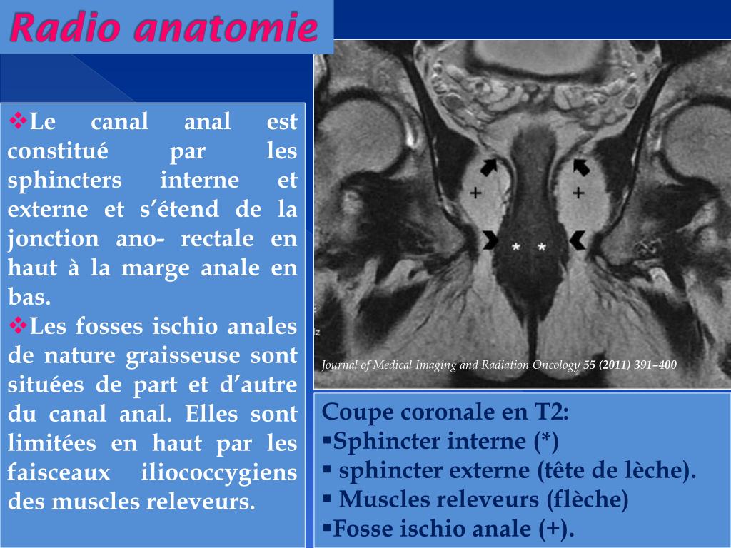 PPT - IRM des fistules ano périnéales PowerPoint Presentation, free ...