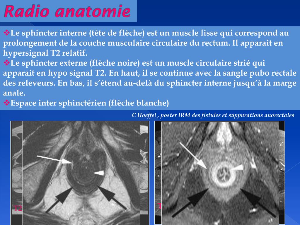 PPT - IRM des fistules ano périnéales PowerPoint Presentation, free ...