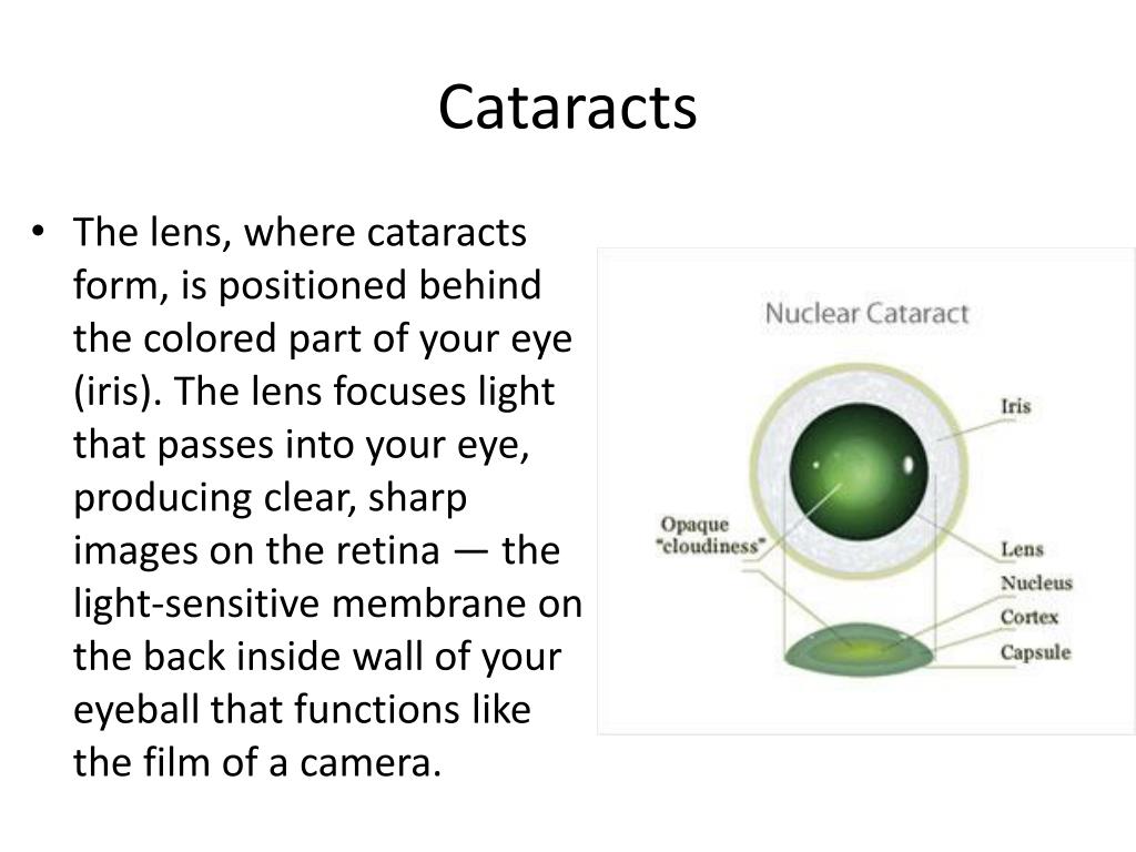 PPT - Cataract Surgery & Premium IOLs PowerPoint Presentation, free ...
