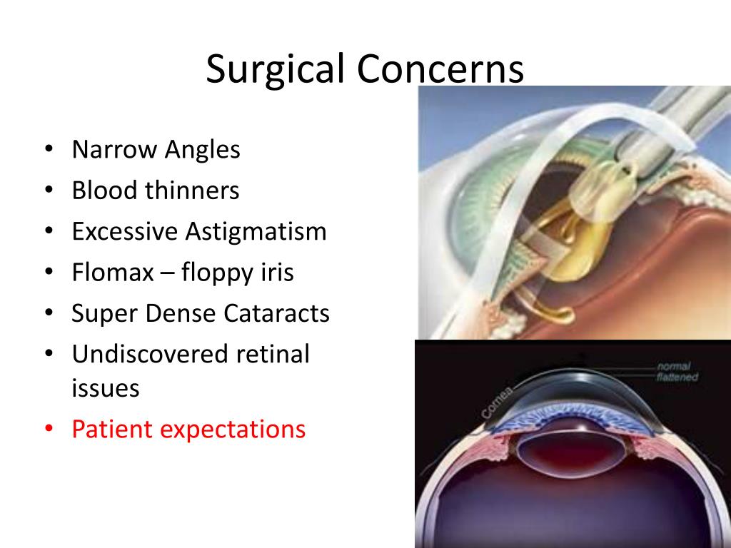 PPT - Cataract Surgery & Premium IOLs PowerPoint Presentation, free ...