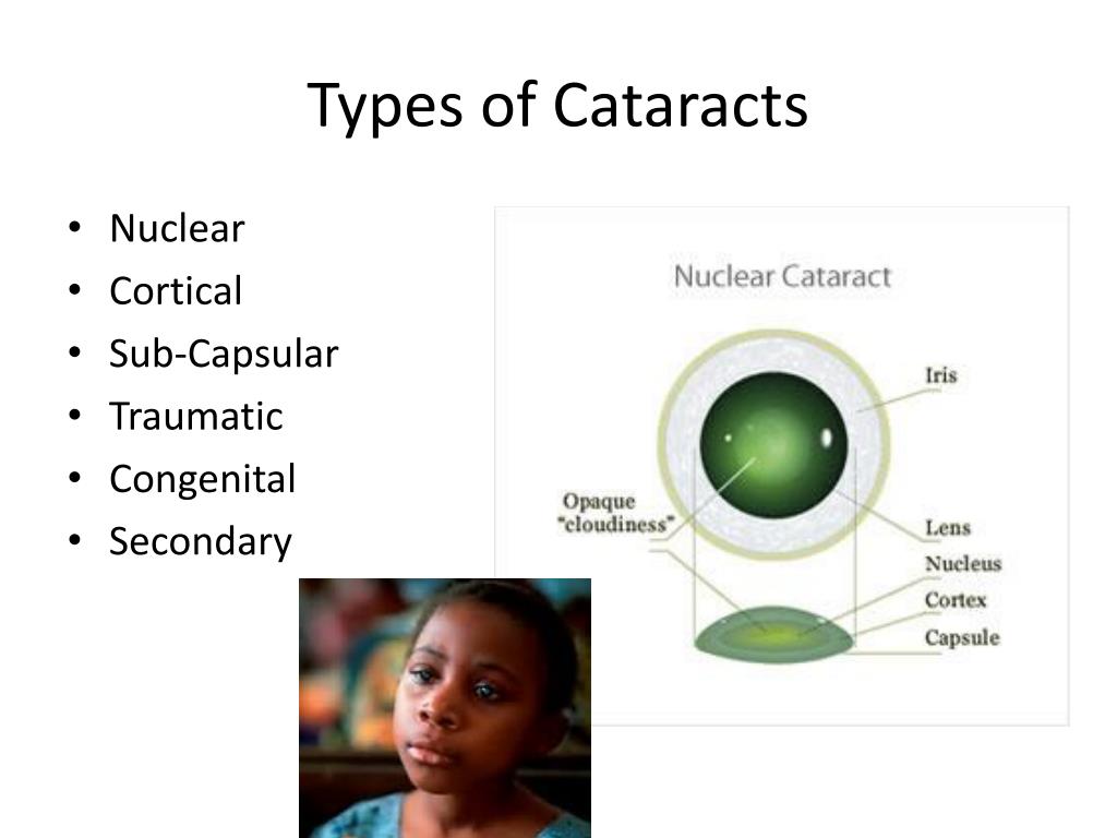 PPT - Cataract Surgery & Premium IOLs PowerPoint Presentation, free ...