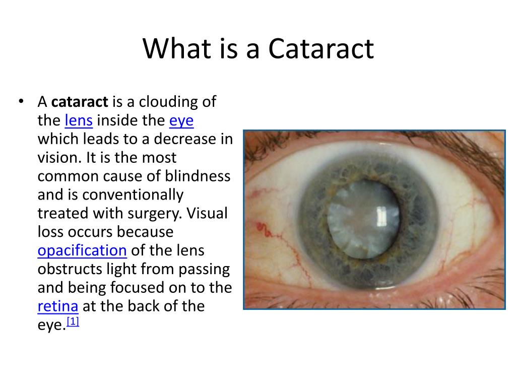 PPT - Cataract Surgery & Premium IOLs PowerPoint Presentation, free ...