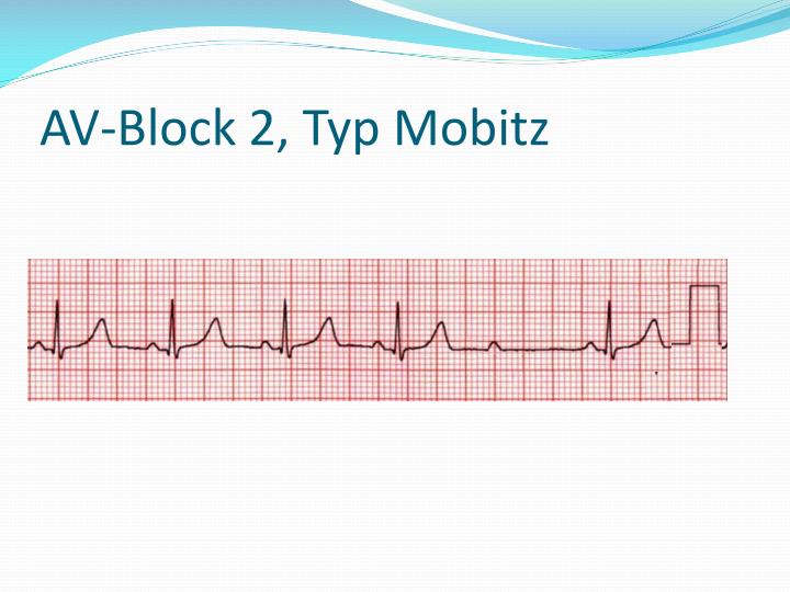 PPT - EKG-Kurs PowerPoint Presentation - ID:2156658