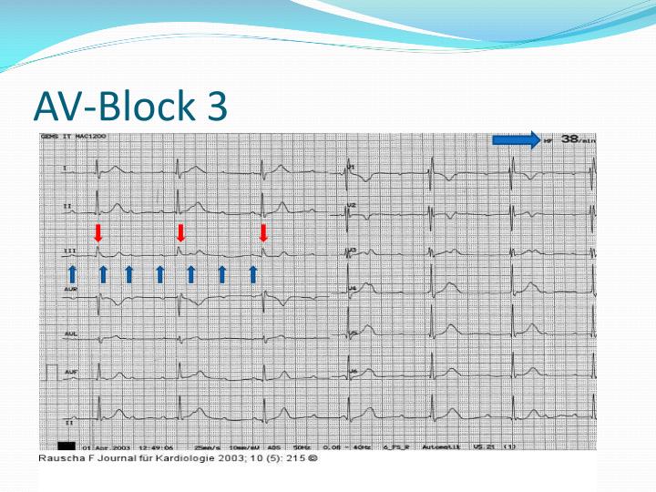 PPT - EKG-Kurs PowerPoint Presentation - ID:2156658