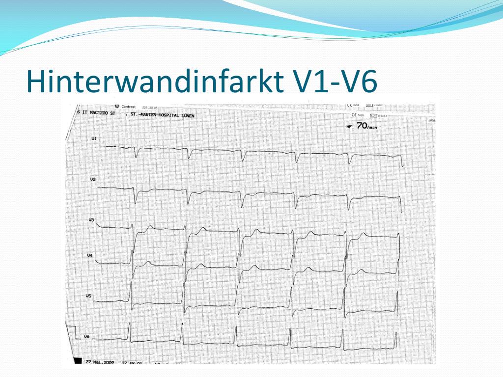 Ppt Ekg Kurs Powerpoint Presentation Free Download Id2156658