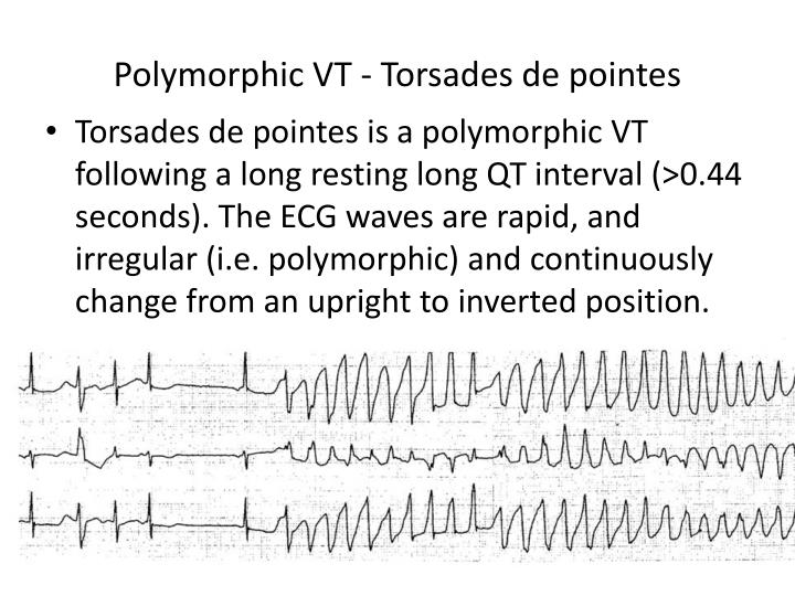 PPT - Ventricular Tachycardia PowerPoint Presentation - ID:2156853