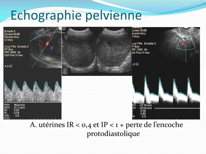 PPT - Cancer de l’endomètre : PowerPoint Presentation - ID:2157998