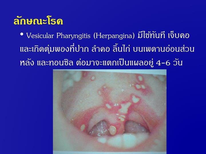 PPT - Coxsackievirus Disease PowerPoint Presentation - ID:2159278