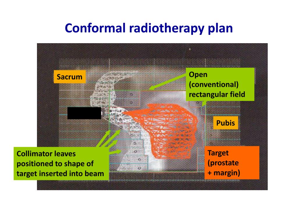 PPT - New Ways of Managing Prostate Cancer Jahangeer M.Malik Consultant ...