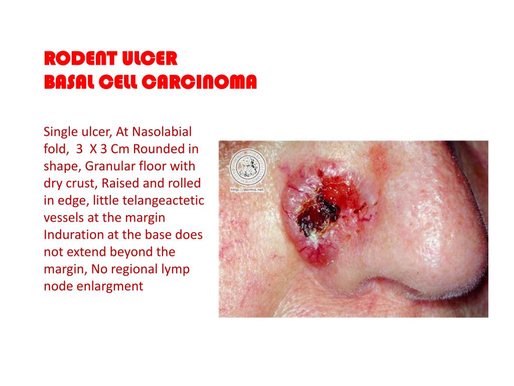 Ppt Skin Tumours Powerpoint Presentation Free Download Id 2160396