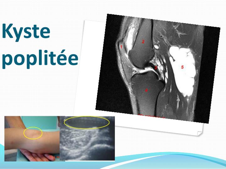 PPT - Douleurs du genou Orientation diagnostique Solutions ...