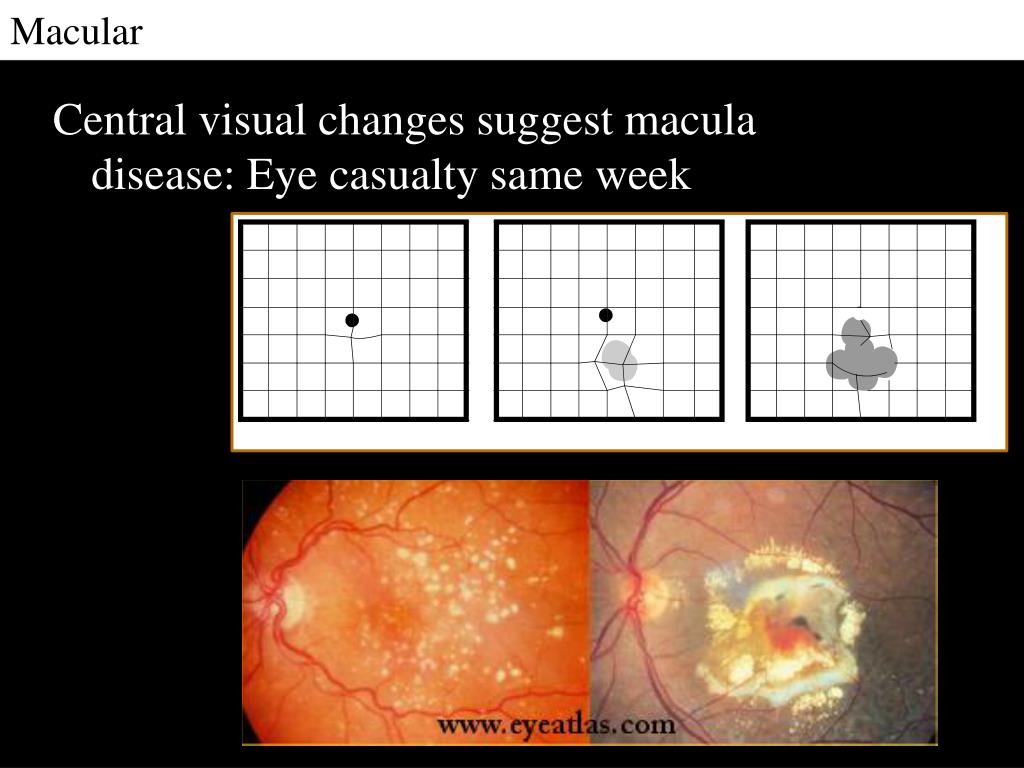 PPT - None-urgent eye problems David Kinshuck, associate specialist ...