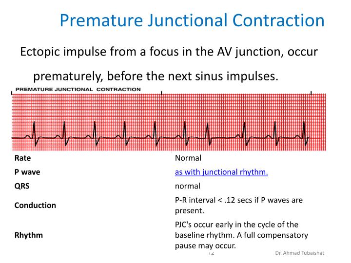 Premature Junctional Contraction Wiki