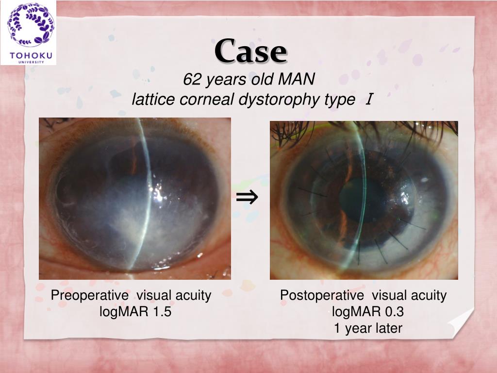PPT - Deep anterior lamellar keratoplasty (DALK) in Tohoku University ...