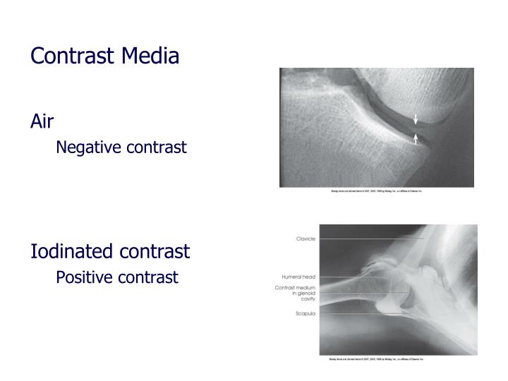 PPT - What is contrast arthrography? PowerPoint Presentation - ID:2161648