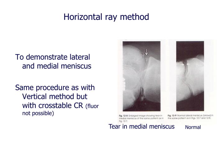 PPT - What is contrast arthrography? PowerPoint Presentation - ID:2161648